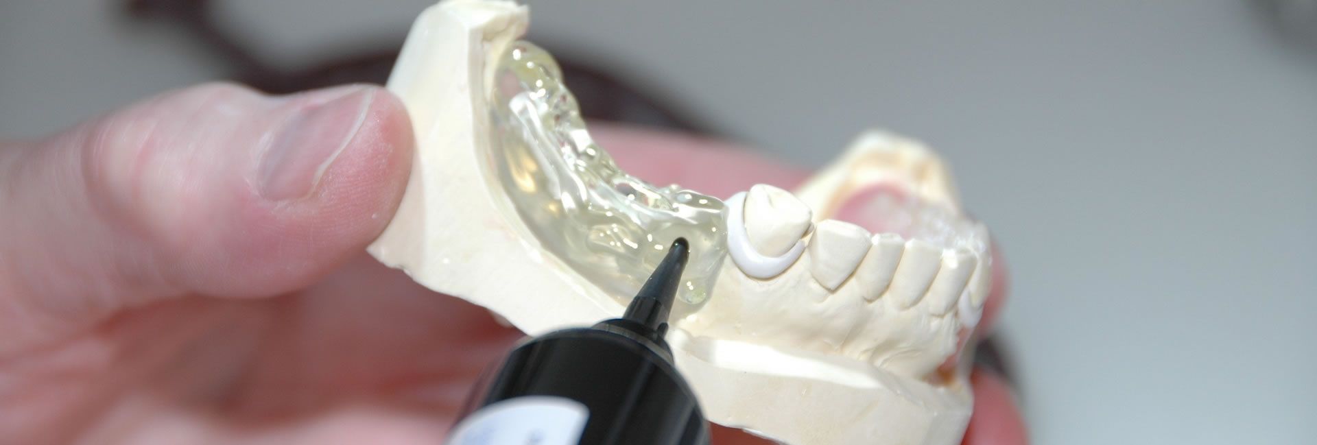 Conjointes (Fixes) - Laboratoire de prothèse dentaire Vanbremeersch